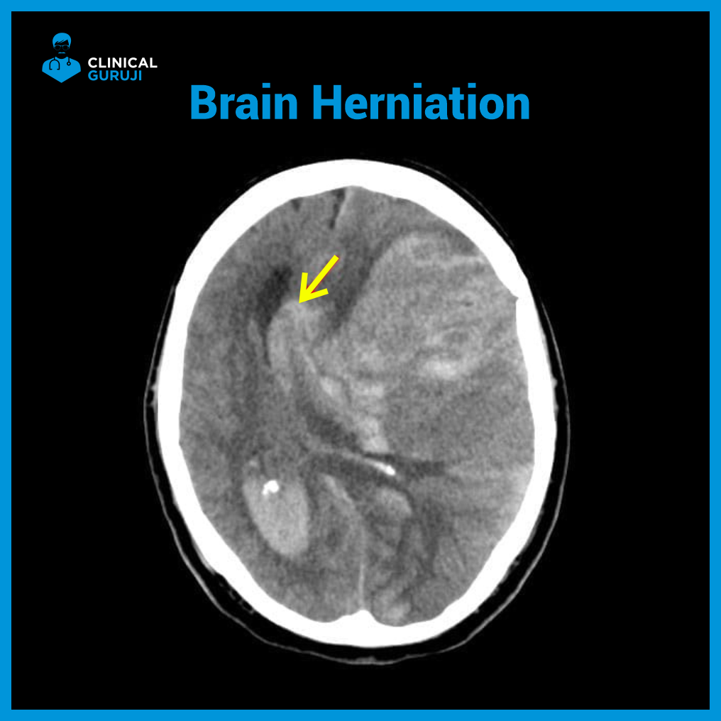 Decoding CT Head Scans: 7 Key Findings for Accurate Diagnoses and ...