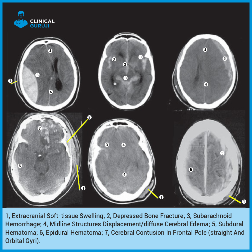 Decoding CT Head Scans: 7 Key Findings for Accurate Diagnoses and ...