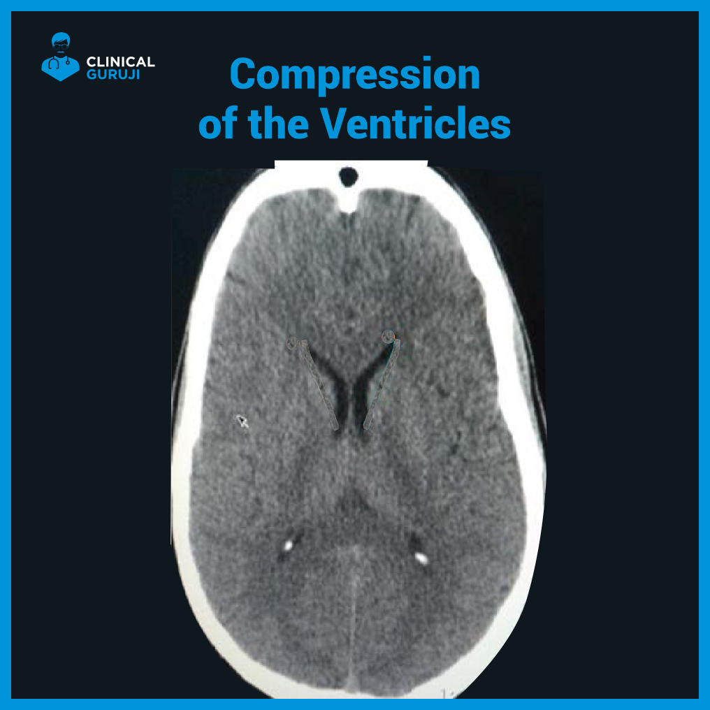 Decoding CT Head Scans: 7 Key Findings for Accurate Diagnoses and ...