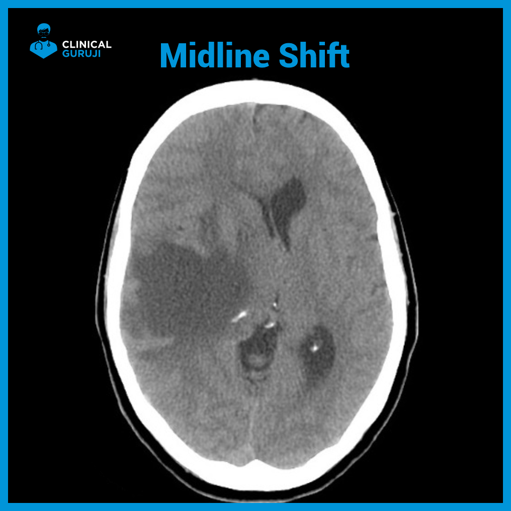 Decoding CT Head Scans: 7 Key Findings for Accurate Diagnoses and ...