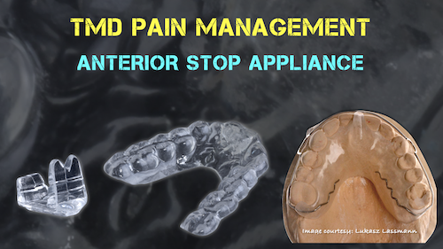 TMD Management: Anterior Stop Appliance Explained